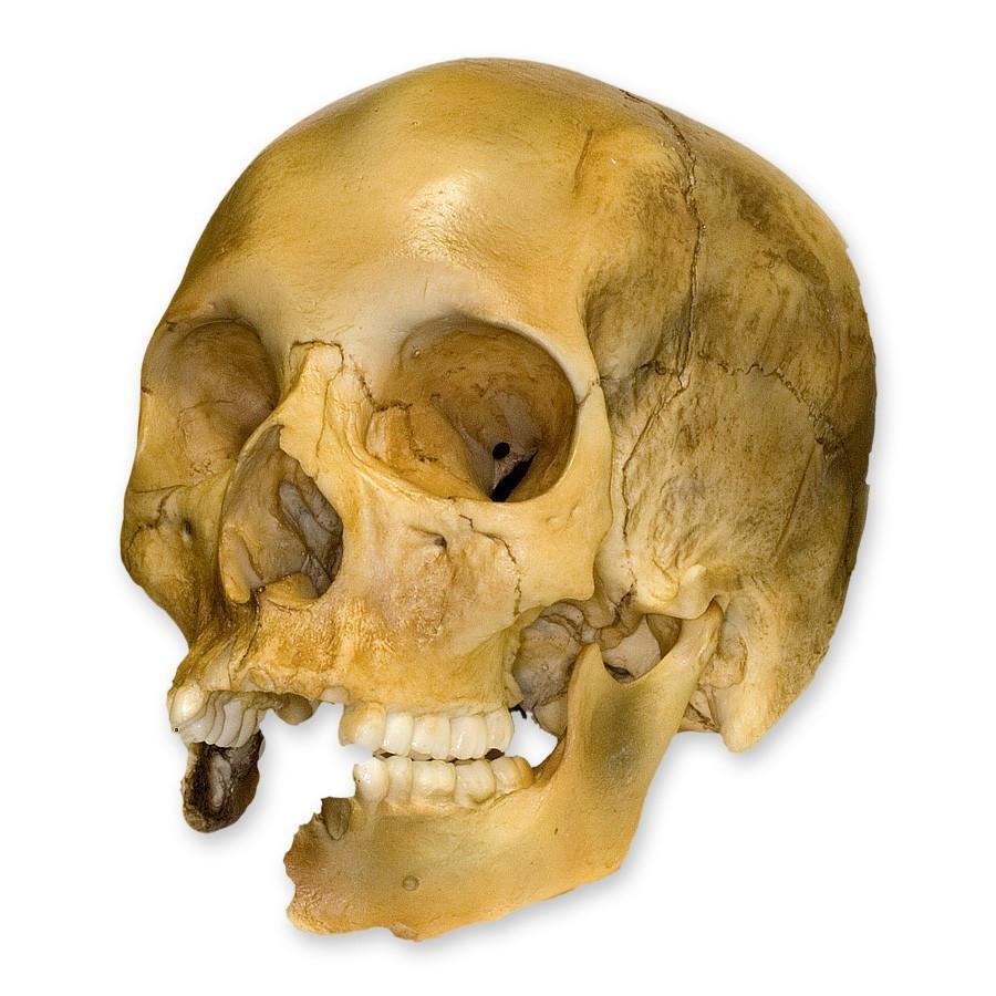 How to "Read" a Skull: Pathology — Skulls Unlimited International, Inc.