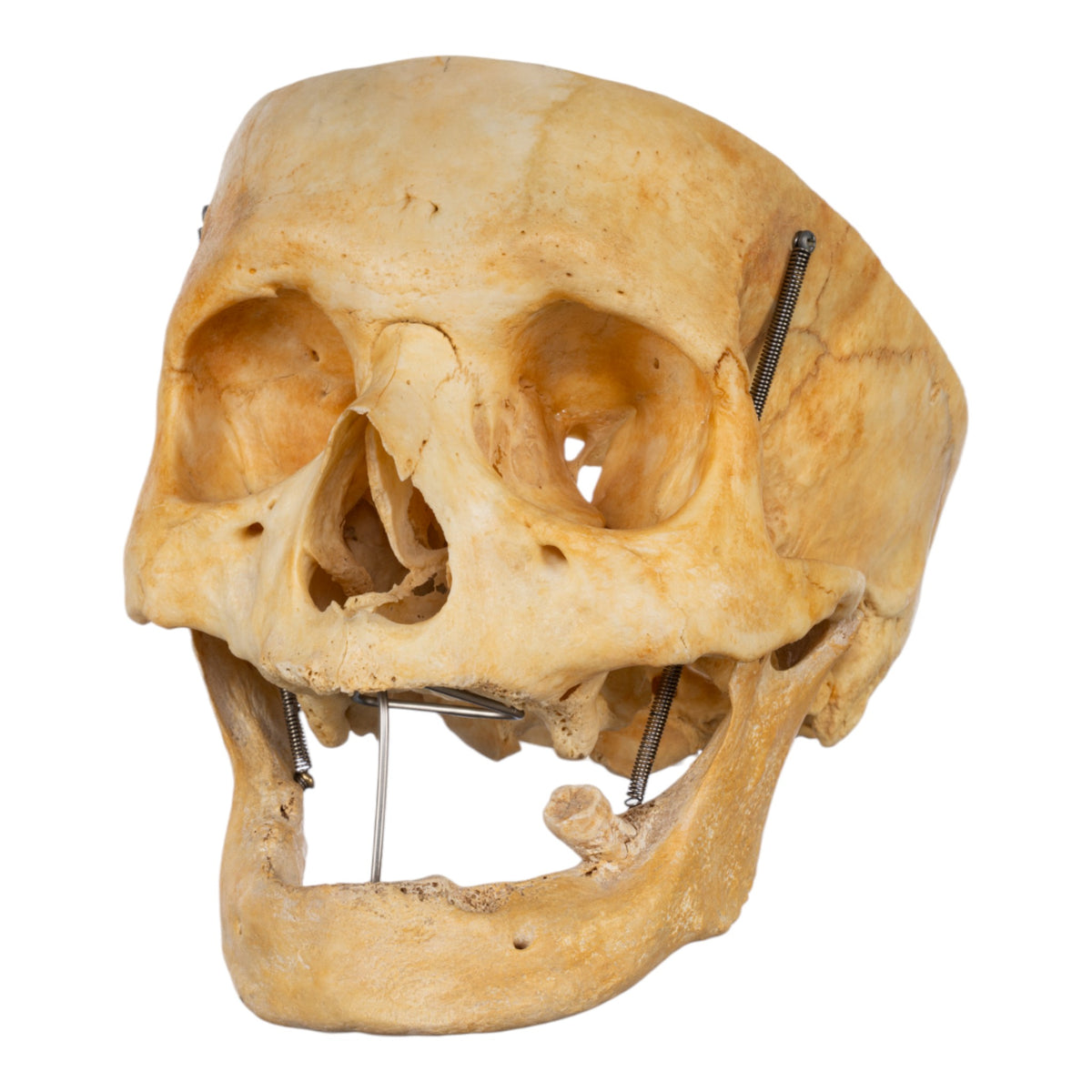 Real Human Partial Skull For Sale — Skulls Unlimited International, Inc.