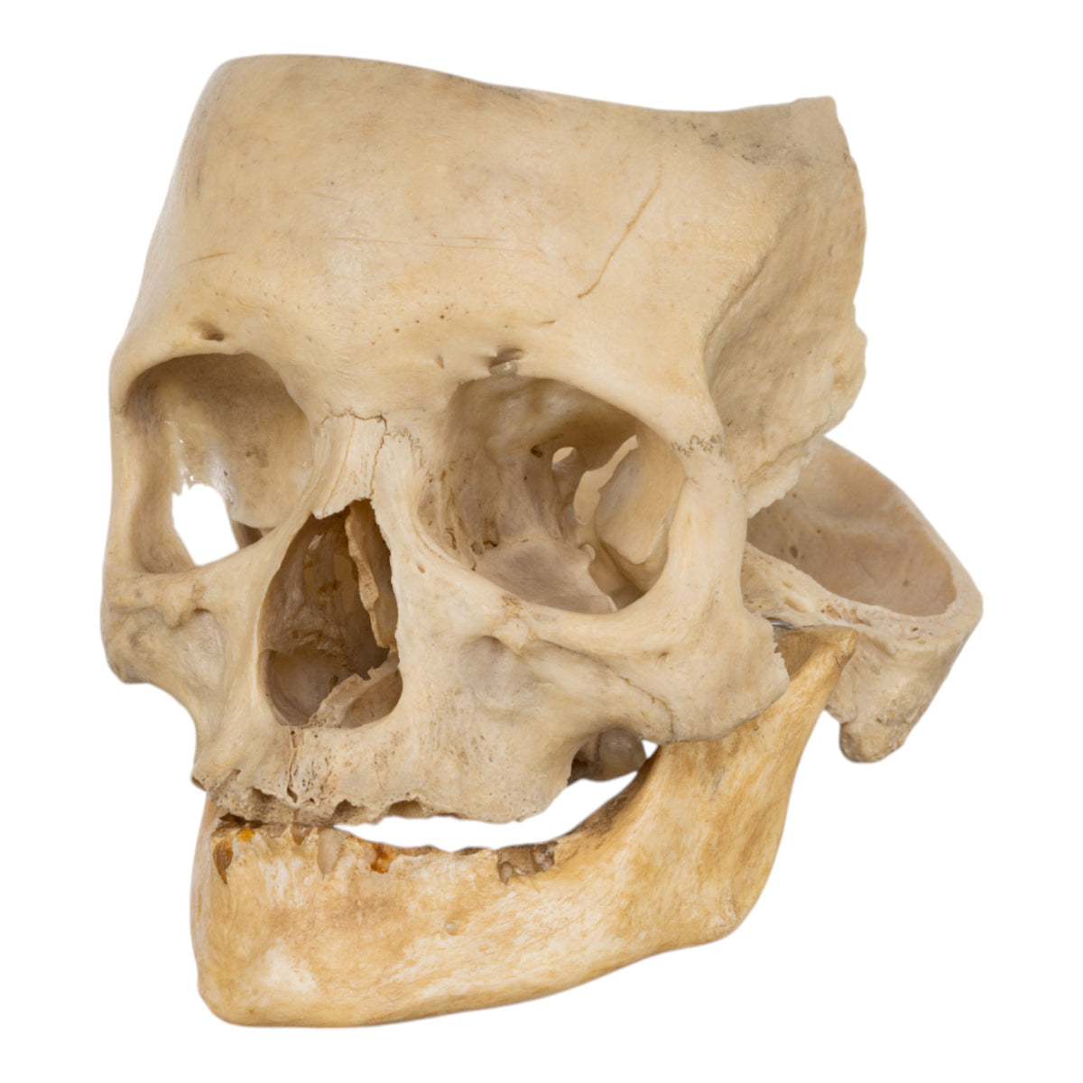 Real Human Partial Skull For Sale — Skulls Unlimited International, Inc.