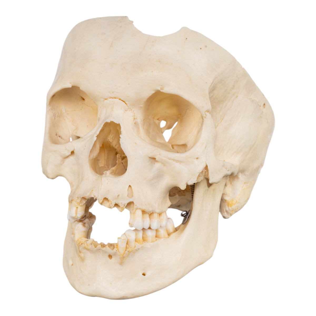 Real Human Partial Skull For Sale — Skulls Unlimited International, Inc.