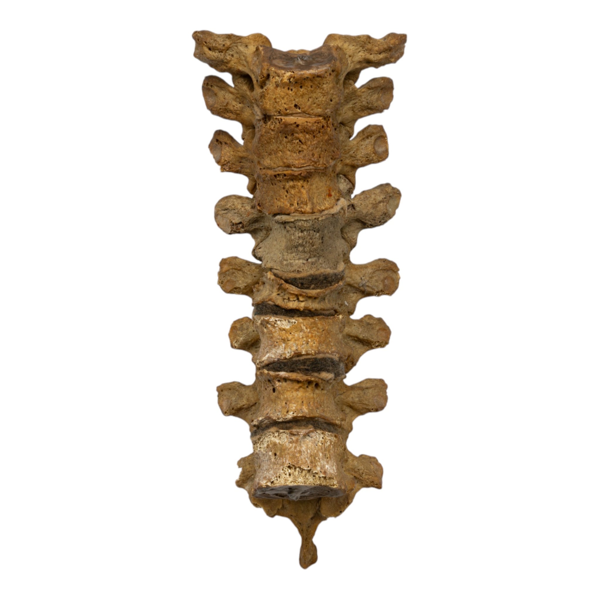 Real Human Thoracic Vertebrae (Set of 8) For Sale — Skulls Unlimited ...