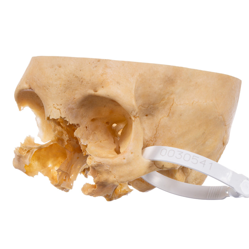 Real Human Partial Skull For Sale — Skulls Unlimited International, Inc.