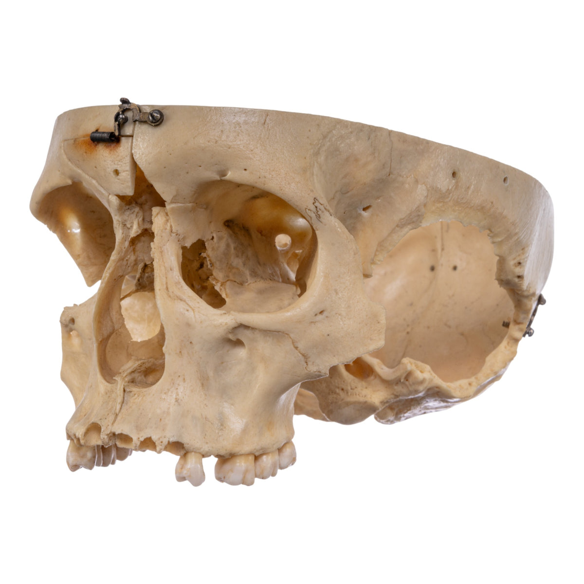Real Human Partial Skull - Dissected For Sale — Skulls Unlimited ...