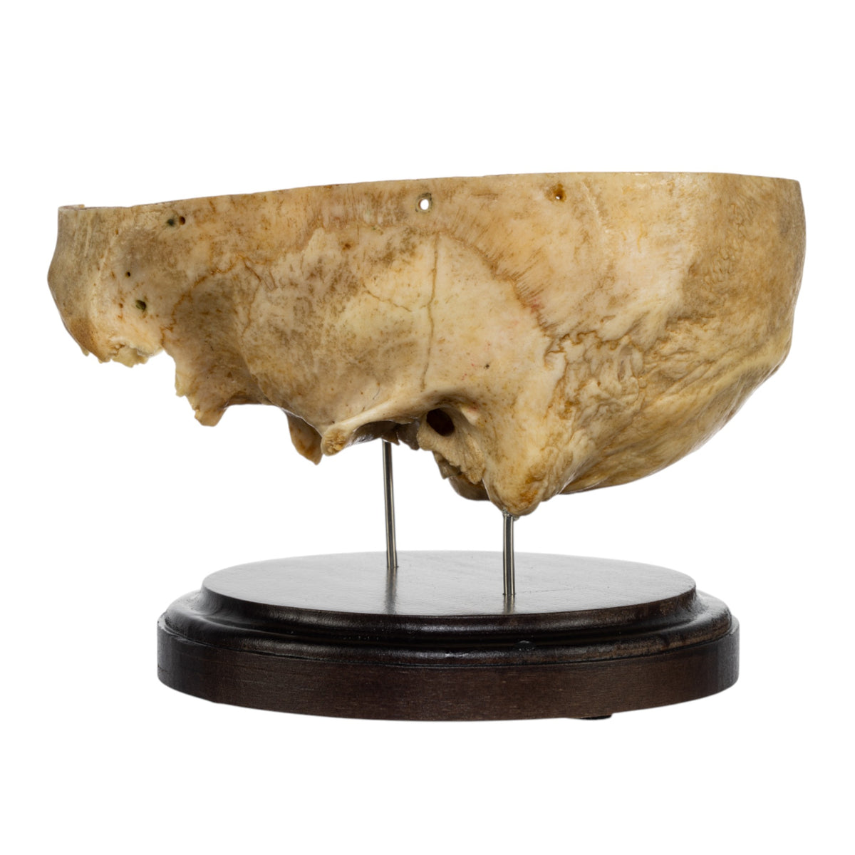 Real Human Partial Skull On Stand For Sale — Skulls Unlimited ...